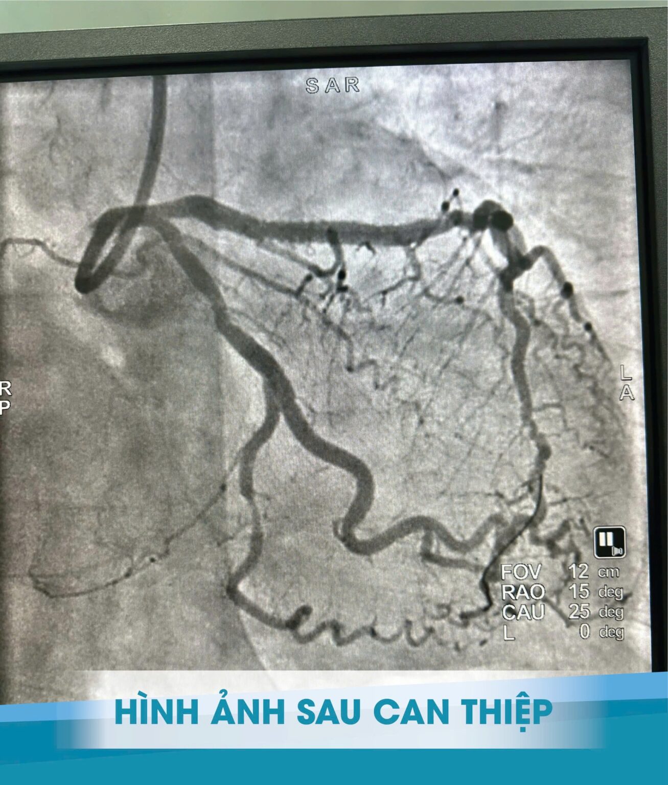 CA CAN THIỆP ĐỘNG MẠCH VÀNH ĐẦU TIÊN TẠI BỆNH VIỆN ĐẠI HỌC Y DƯỢC ...