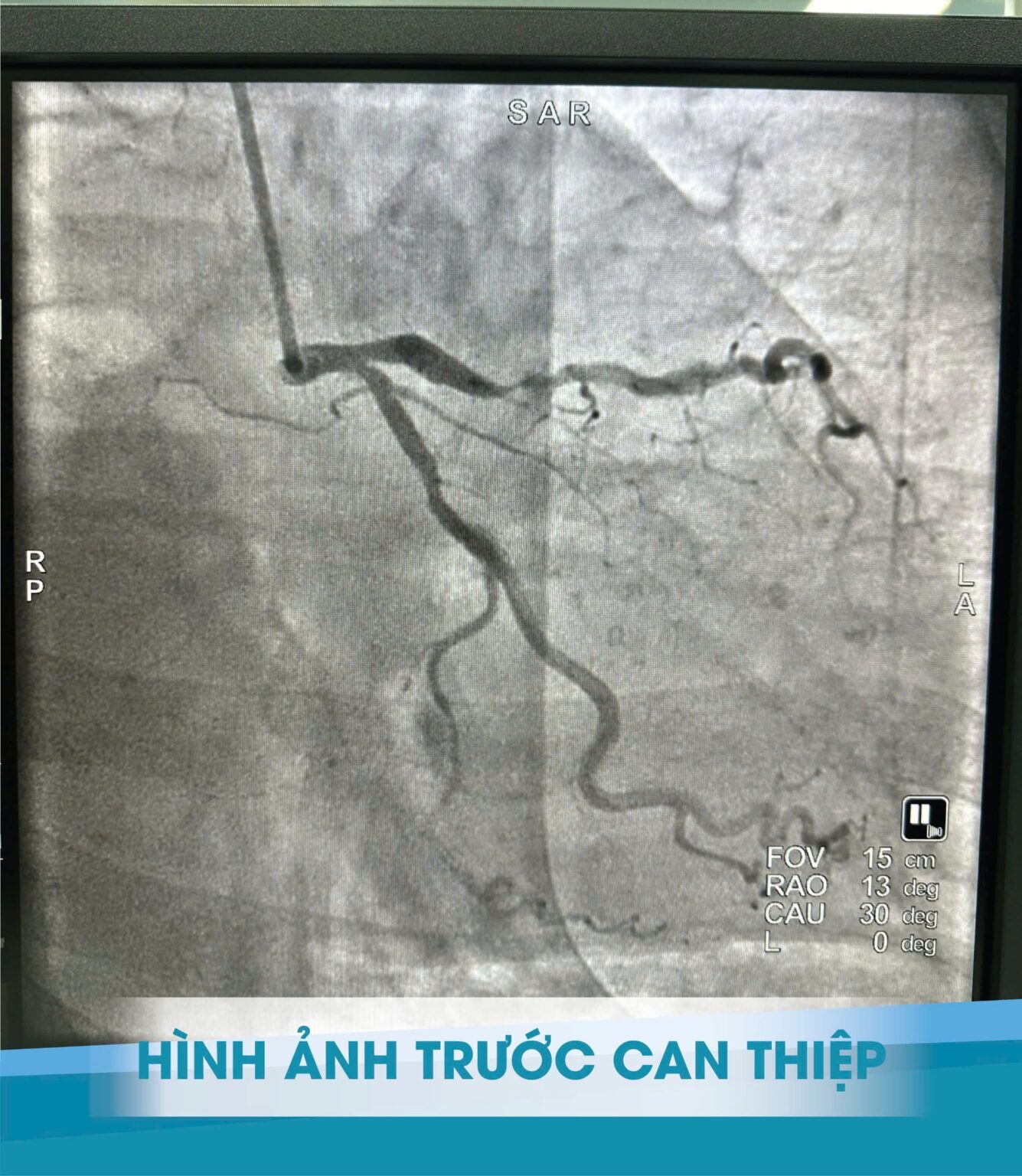 CA CAN THIỆP ĐỘNG MẠCH VÀNH ĐẦU TIÊN TẠI BỆNH VIỆN ĐẠI HỌC Y DƯỢC ...